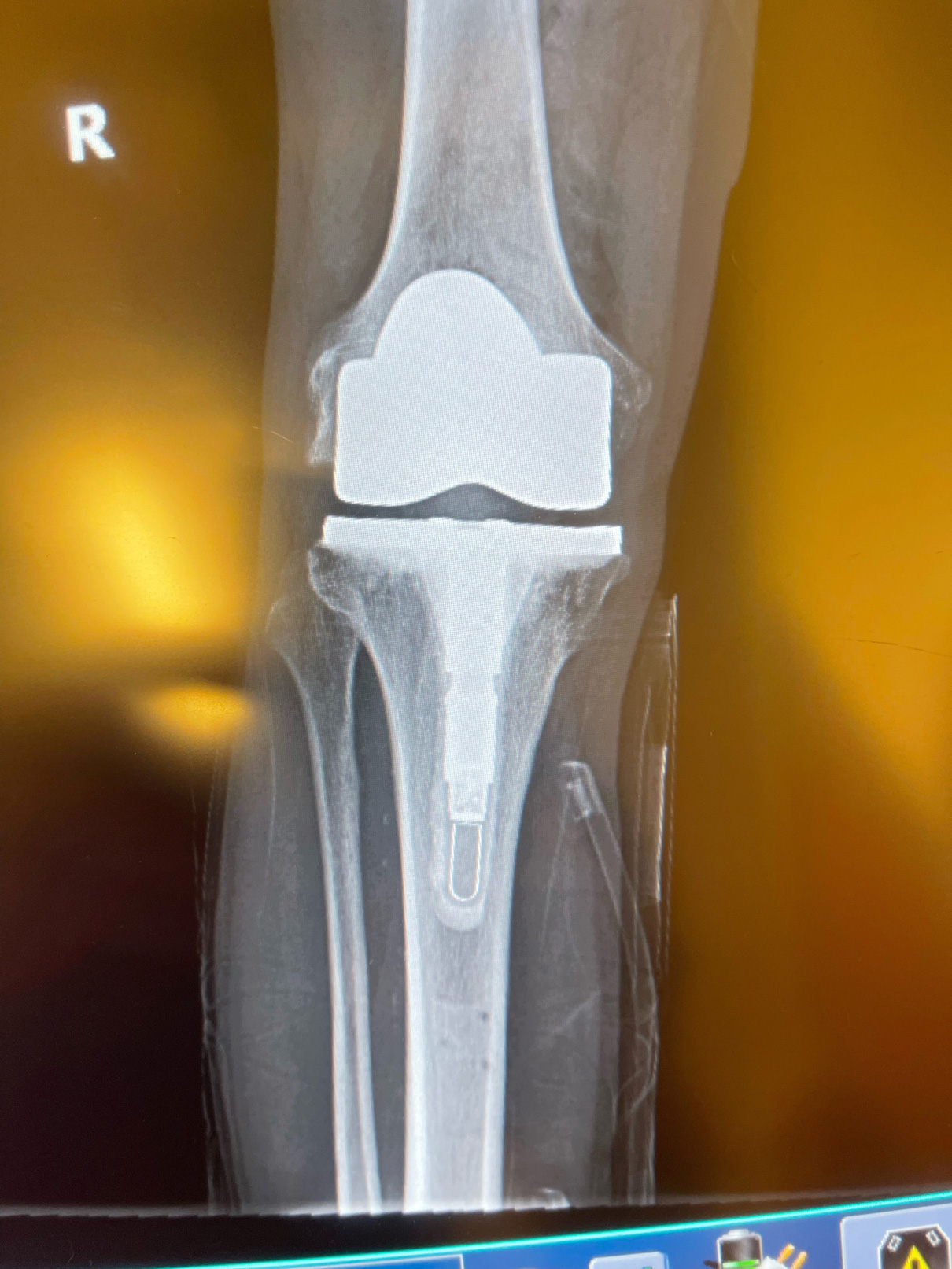 “Smart knee” technology allows knee replacement patients to actively ...
