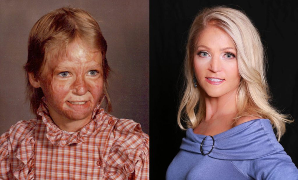 Decades after 70 percent of her body was burned, Colorado mom goes for ...