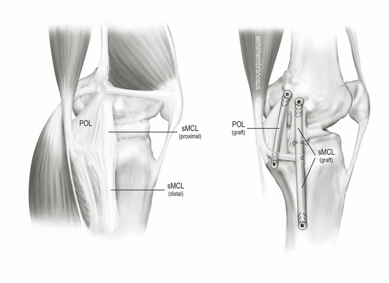 New options, hope for MCL knee injury sufferers | VailDaily.com